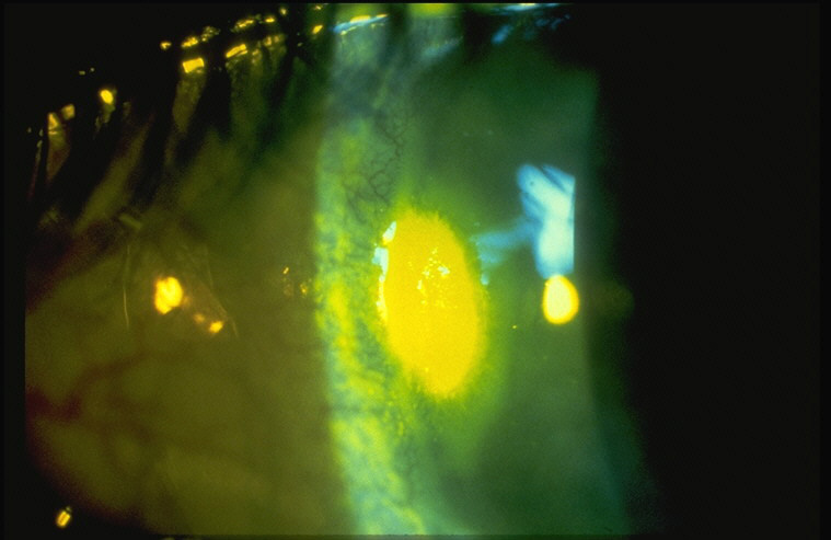 Epithelium : Bausch + Lomb