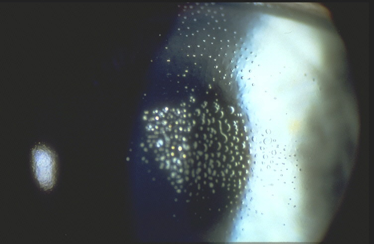 Epithelium : Bausch + Lomb