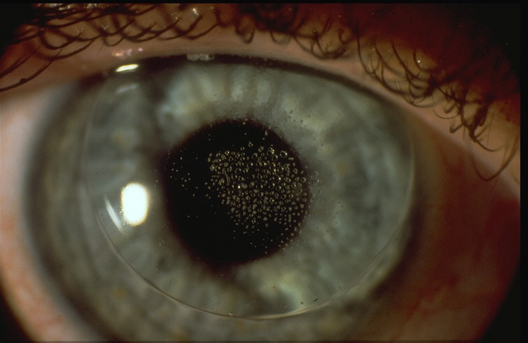 Epithelium : Bausch + Lomb