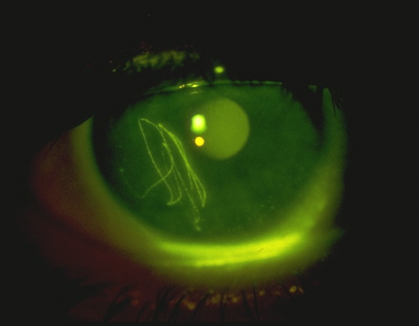 Epithelium : Bausch + Lomb