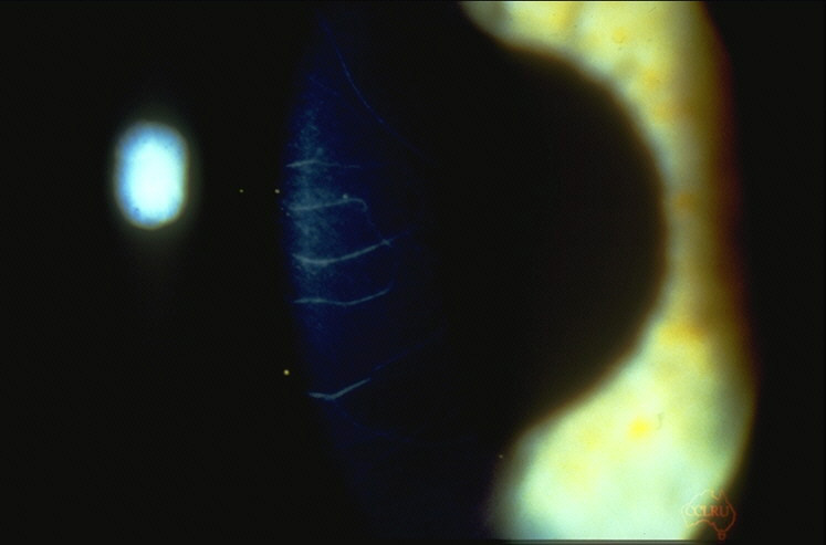 Epithelium : Bausch + Lomb