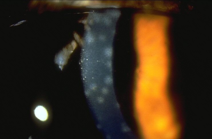 Epithelium : Bausch + Lomb