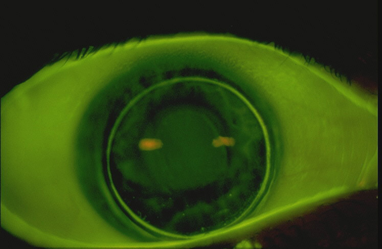 GP and PMMA Contact Lenses : Bausch + Lomb