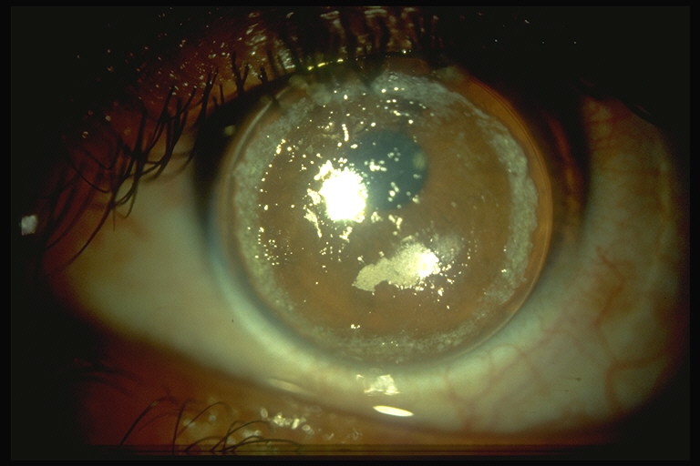 GP and PMMA Contact Lenses : Bausch + Lomb