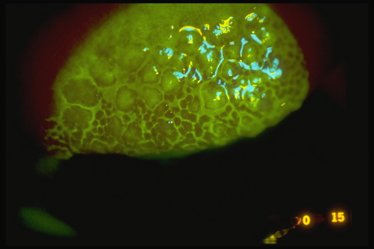 Lids and Palpebral Conjunctiva- photos : Bausch + Lomb