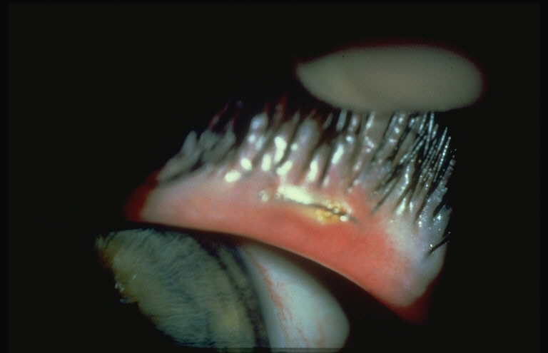 Lids and Palpebral Conjunctiva- photos : Bausch + Lomb