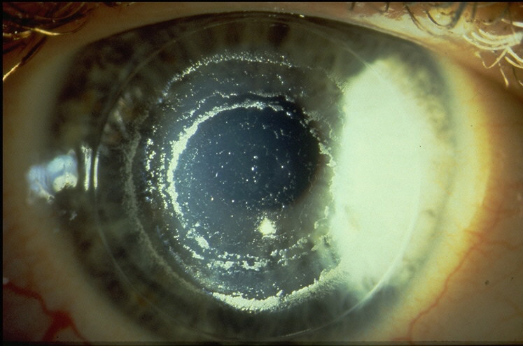 Soft Contact Lenses : Bausch + Lomb